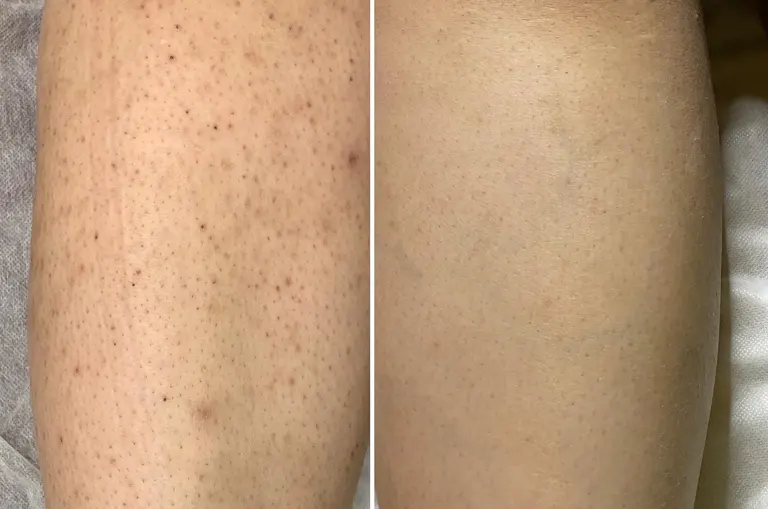 Dermabolt® IPL